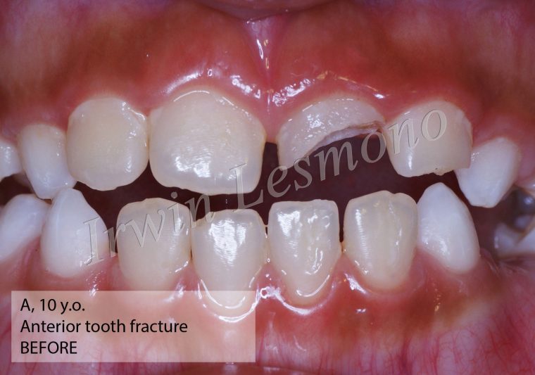 Perawatan Saluran Akar Gigi - Klinik DENTA: