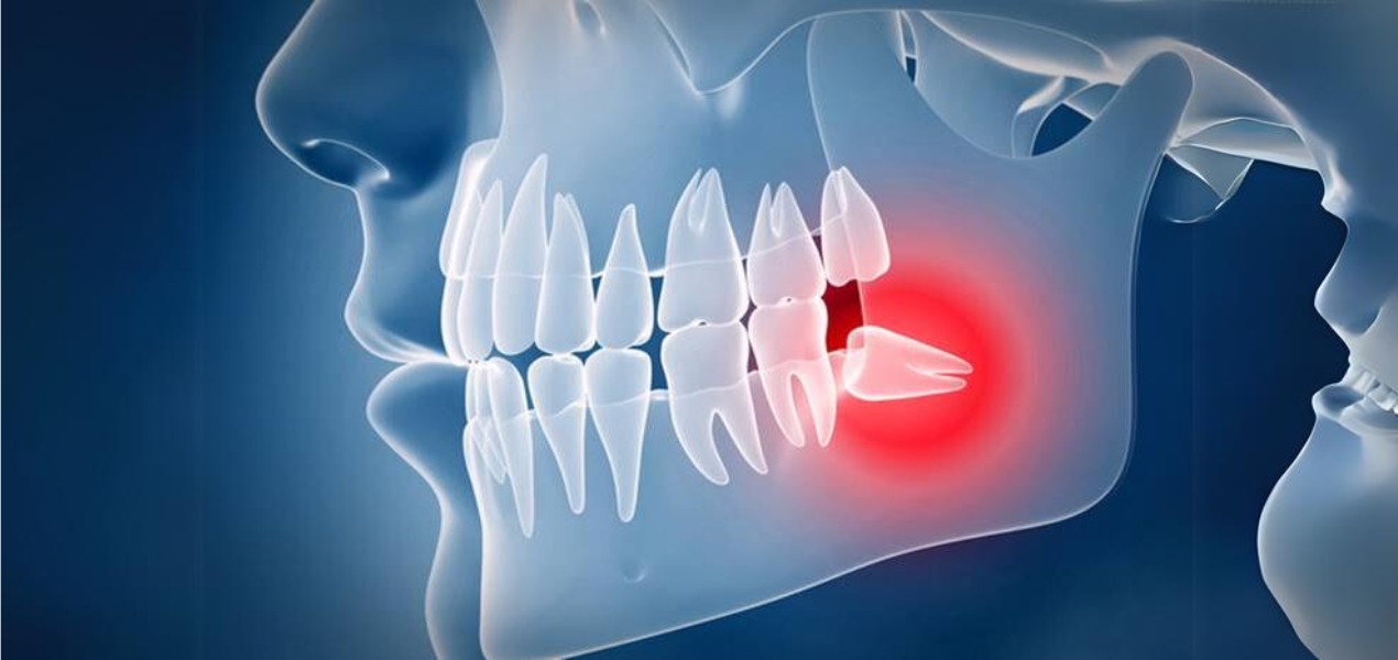 Penyebab Gigi Tumbuh Miring dan Mengatasinya Secara Alami